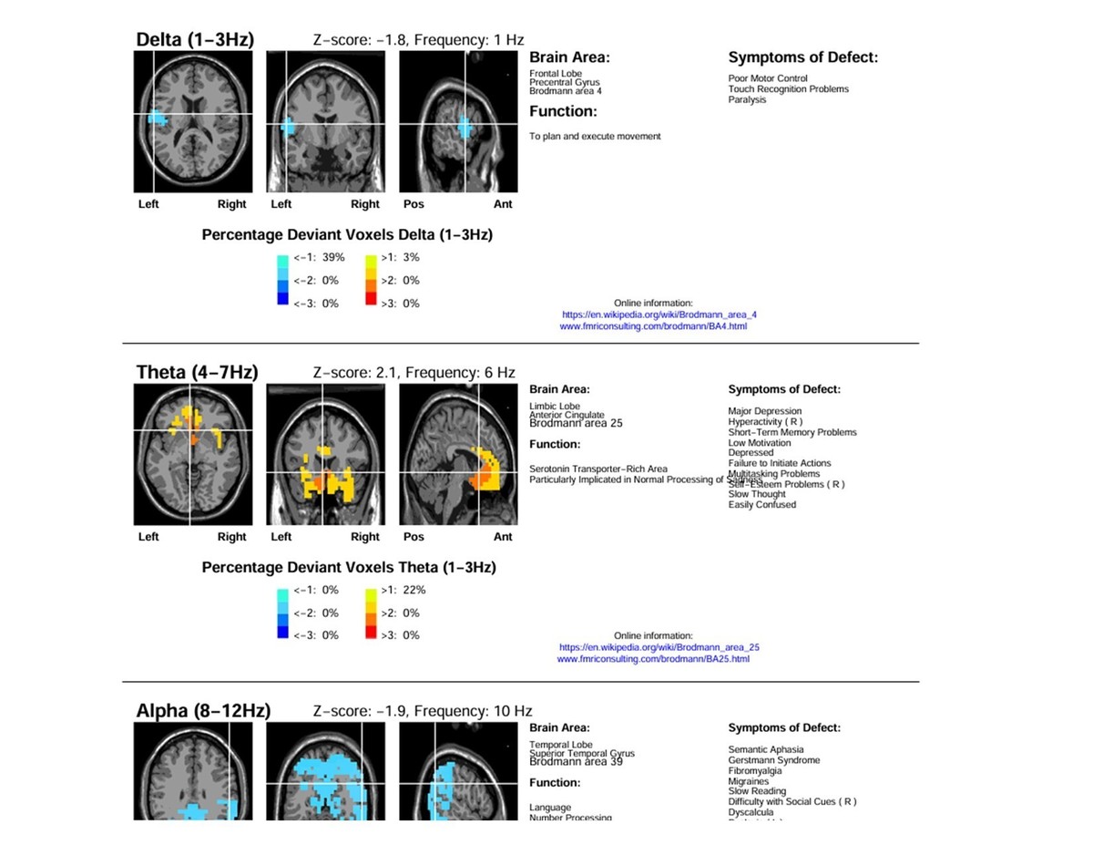 The Benefits of LORETA-Style qEEG: | Neurofeedback | O'Keefe Matz Chiropractic & Functional ...